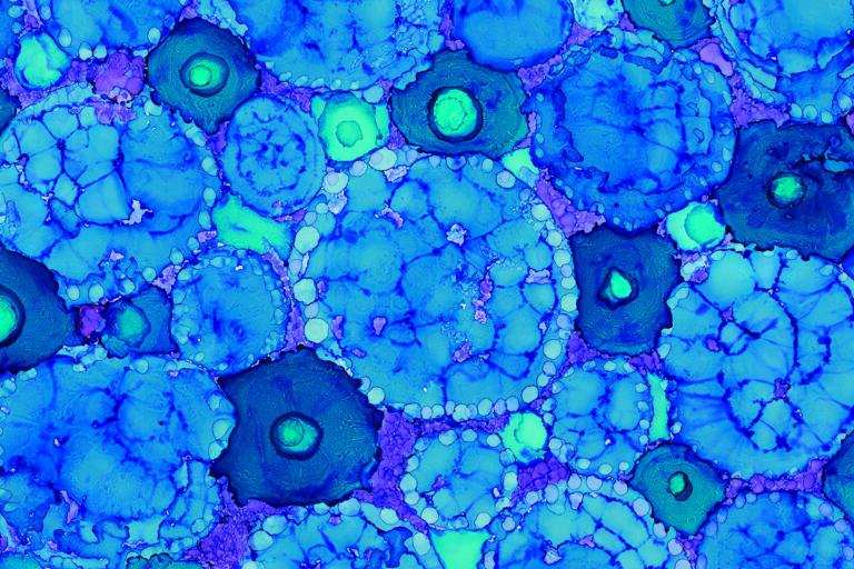 Cell therapies - Breakthrough T1D